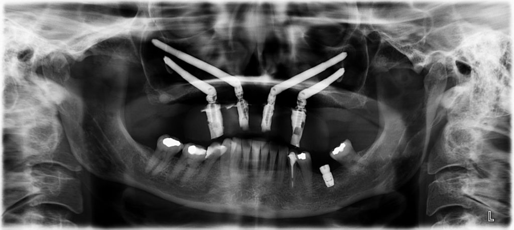Implant zygomatique - Maxillo
