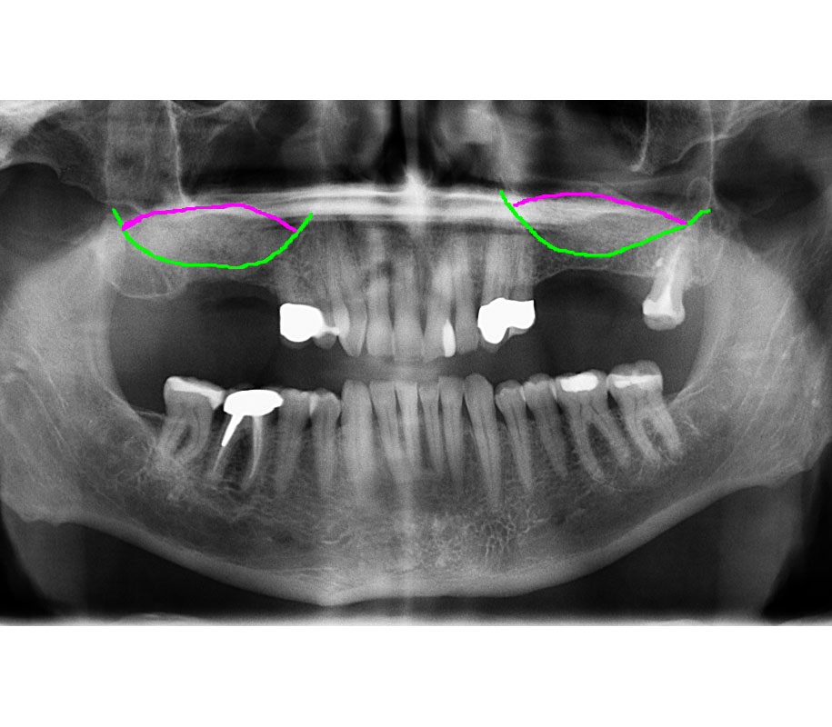 Greffe osseuse - Maxillo